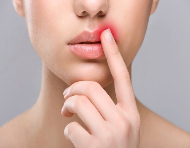 boqueras como curarlas :: Boqueras